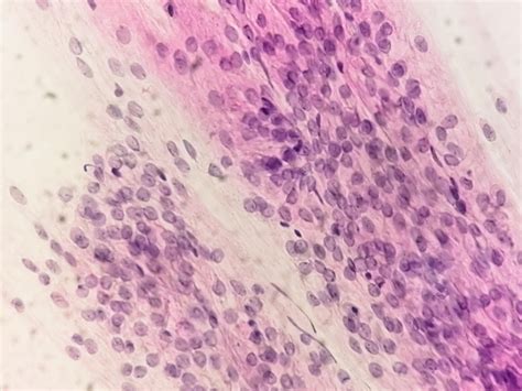 Premium Photo Trichomonas Vaginalis In Pap Smear With Few Acute