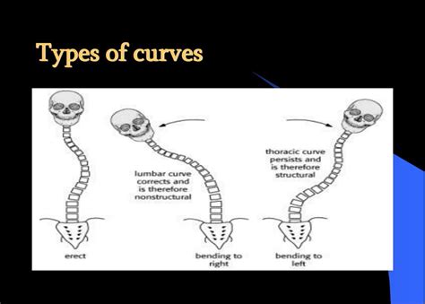 Ppt Scoliosis Powerpoint Presentation Free Download Id 3135714