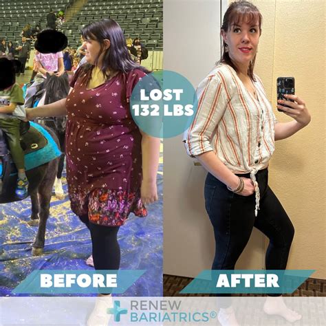Gastric Bypass Before And After Young
