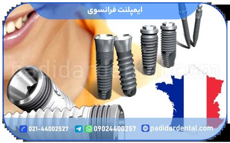 ایمپلنت فرانسوی بررسی قیمت انواع برند مزایا و معایب