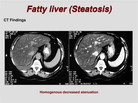 PPT Diffuse Liver Disease PowerPoint Presentation Free Download ID 6644888