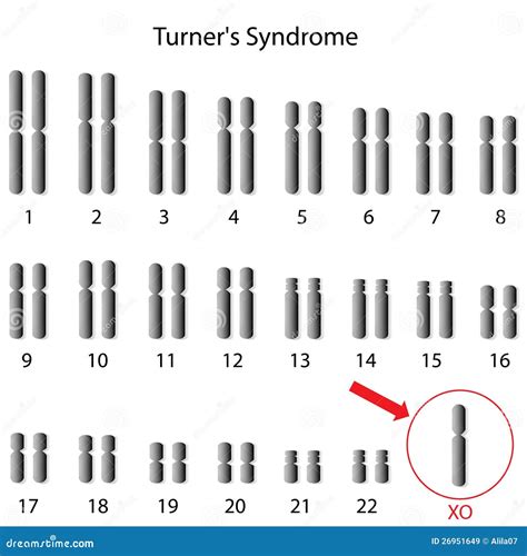 Turner Syndrome Stock Vector Image Of Chromosomal Karyotype 26951649
