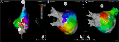 A Case Of Biatrial Tachycardia Via The Epicardial Connection Between