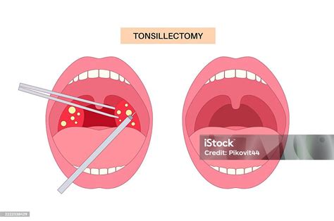 Tonsillectomy Procedure Poster Stock Illustration Download Image Now