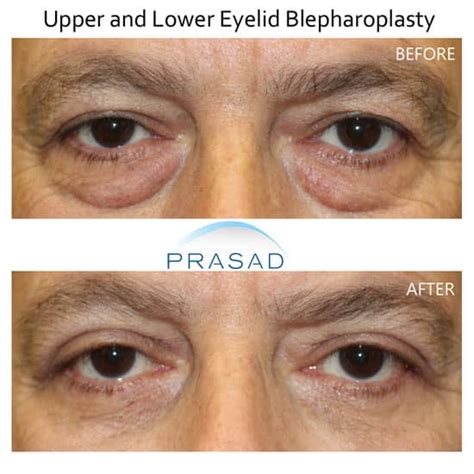 How Safe Is Under Eye Bag Removal Surgery Dr Prasad Blog