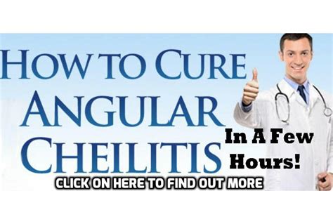 How To Have A Healthy Life Most Common Causes Of Angular Cheilitis And