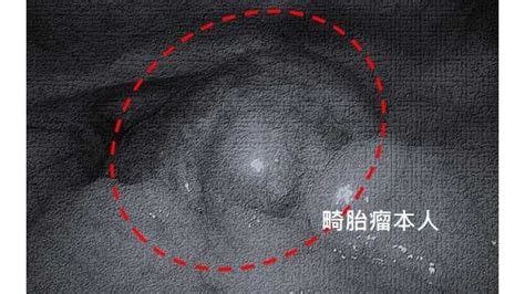 畸胎瘤，單孔腹腔鏡治療 李維鈞 醫師 Obsgyn071 Dcard