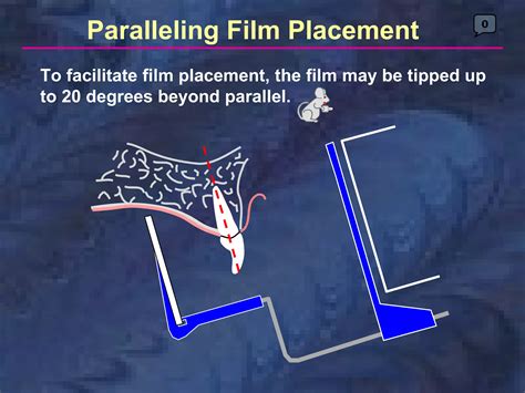 Radiology Paralleling Technique Pdf