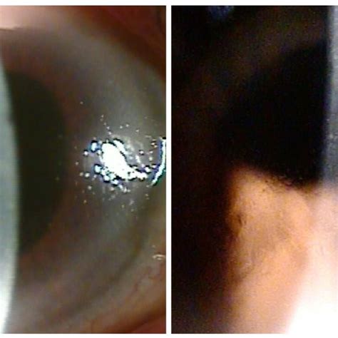 Pdf Epstein Barr Virus Related Corneal Endotheliitis Accompanied With