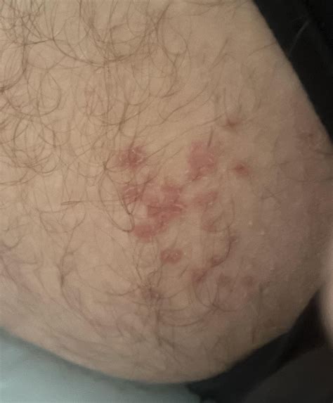 Inner Thigh Rash Rskin