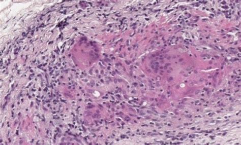 Multinucleated Giant Cells Gca Histology