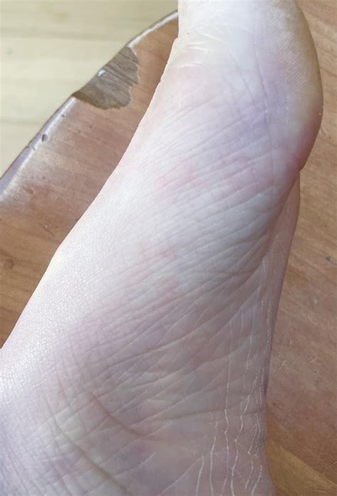 Splotchy Purple Rash On Foot R Autoimmune