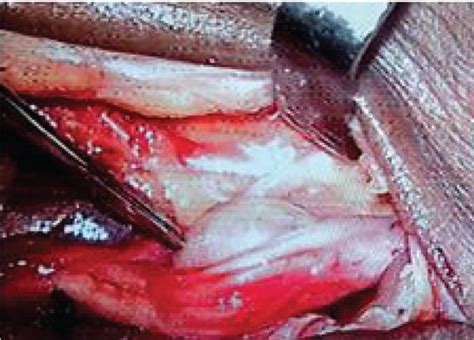 Intraoperative Images A B Showing Excision Of The Mass Which Was Download Scientific Diagram