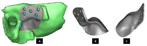 Design And Finite Element Analysis Of Patient Specific Total Temporomandibular Joint Implants