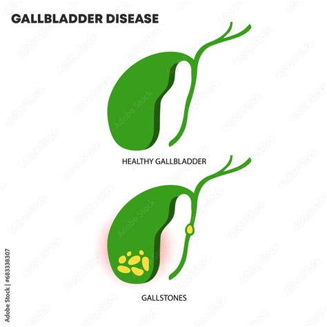 Gallstones Anatomy Inflamed And Healthy Gallbladder Stones In The Gallbladder Vector Design