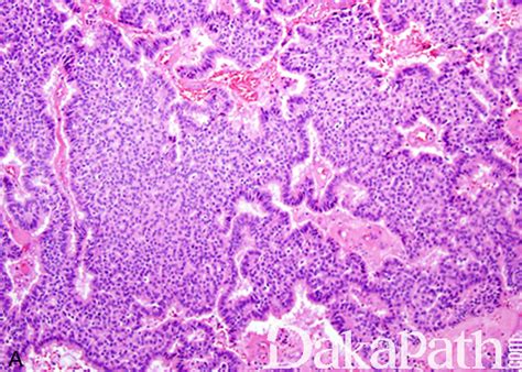 前列腺高分化神经内分泌肿瘤