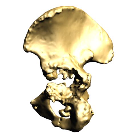 Case 27 Revision Of A Loose Cup Due To Massive Superior Acetabular Osteolysis From Polyethylene