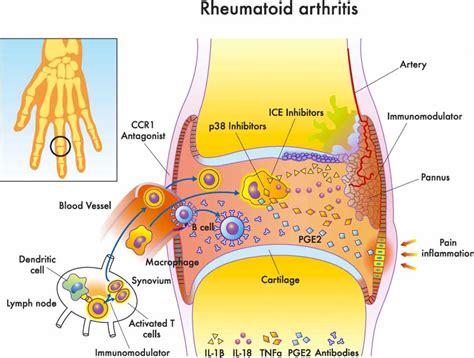 Acupuncture Alleviates Rheumatoid Arthritis Swelling And Pain