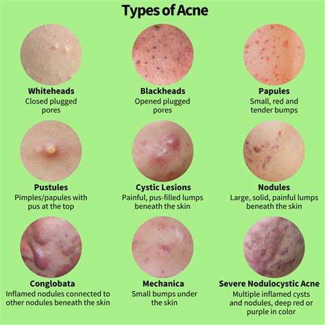 All About Acne Part 1 The Causes