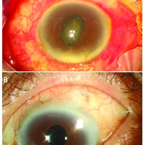 A Anterior Segment Revealed Opacified Bleb Surrounded By Hyperemic Download Scientific