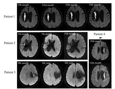 Figure Longitudinal Mri Scans Of F Dwi Patients With Ich Ws