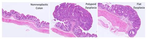 Low Power View Of Non Neoplastic Colon And Dysplasias In The Aomdss