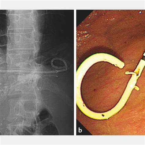 A Dedicated 7f × 14 Cm Plastic Stent Type It Stent Gadelius Medical Download Scientific