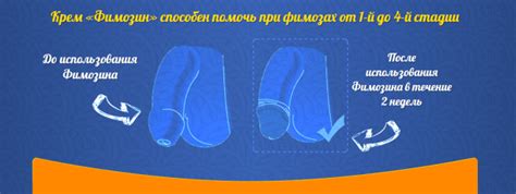 Купить Фимозин при фимозе в Новошахтинске в интернет аптеке AptekaProm ...
