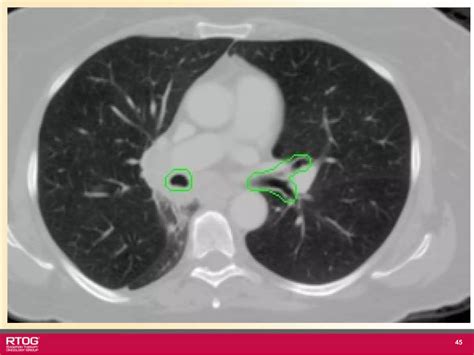 Rtog 1106 Oar Atlas Thoracic Radiation Therapy Ppt