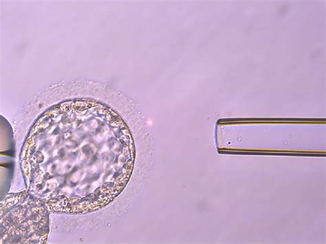Ahmad Awartani On Linkedin Trophectoderm Biopsy For A Hatching Blastocyst Embryo When The Icm