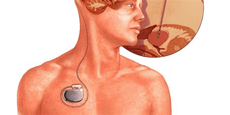Deep Brain Stimulation Transforming Lives With Neurosurgery