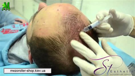 Лечение выпадения волос. Как применять мезороллер для головы методика ...
