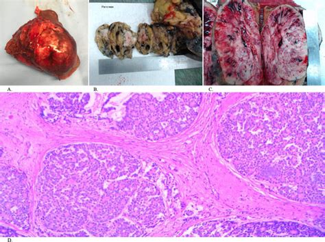 Histopathology Post Operative Specimens A Left Hemihepatectomy Download Scientific Diagram