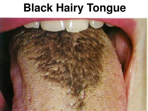 Medical Terminology For Black Tongue At Gerald Parish Blog
