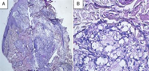Criptococosis Diseminada Con Afectación Cutánea En Un Paciente Con Sida