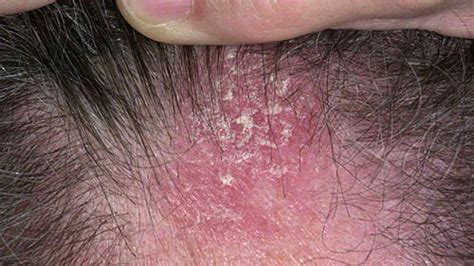 Dermatitis Herpetiformis Scalp
