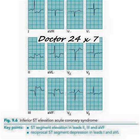 Amudu Easy Way To Learn Ecg Step By Step In A Very Easy Way