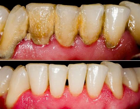 Gingivitis Symptoms Causes Treatment And Prevention Dr Salim