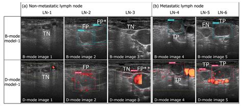 Successful And Unsuccessful Examples Of Metastatic Lymph Node Detection
