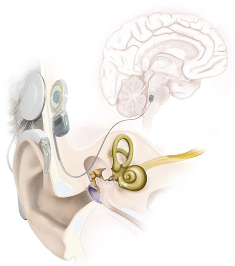 Auditory Brainstem Implant Evelina London