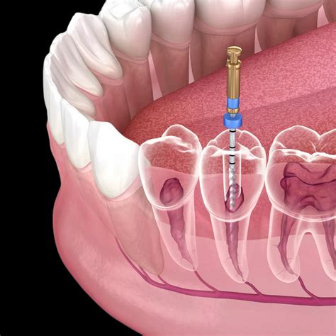What Exactly Is Root Canal Therapy The Grace Dental