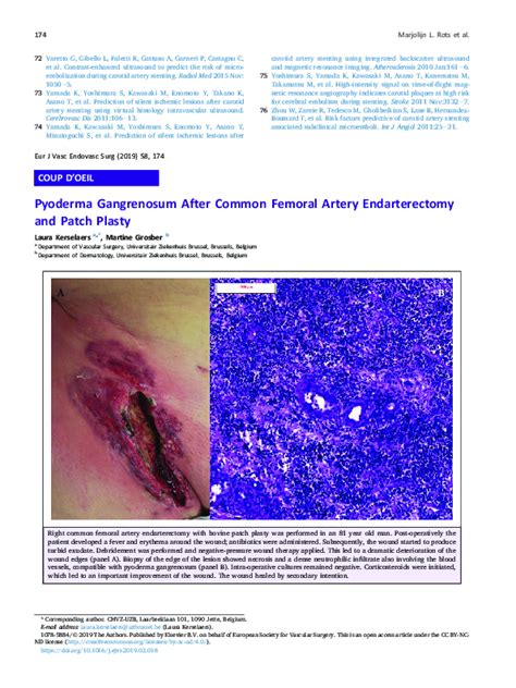 Pdf Pyoderma Gangrenosum After Common Femoral Artery Endarterectomy And Patch Plasty Laura