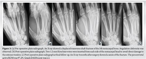 Clinical Outcomes Of Retrograde Percutaneous Pinning For Shaft Fracture