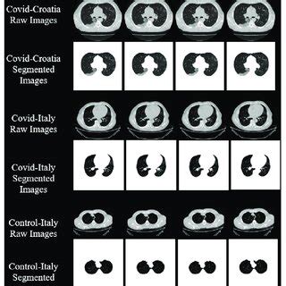 Overall Pipeline Consisting Of CT Volume Acquisition HDL Based