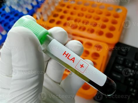 Test Tube With Blood Sample For HLA Or Human Leukocyte Antigen Test Stock Photo At Vecteezy