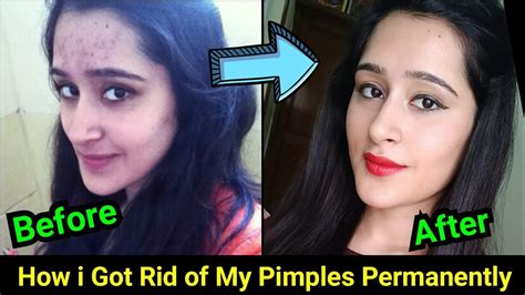 How To Remove Pimples Acne Pimple Marks Completely ThatGlamGirl YouTube