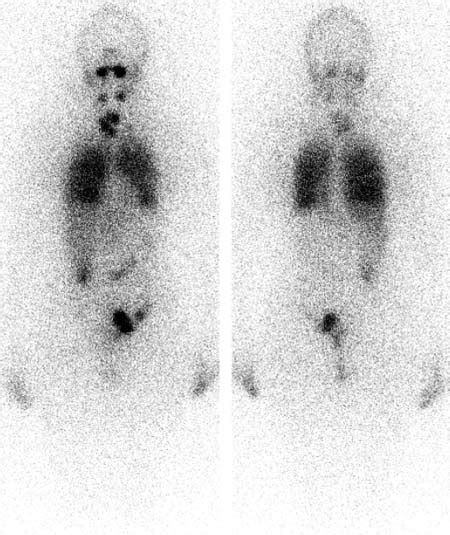62 Pulmonary Metastasis Radiology Key
