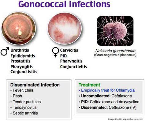 Gonococcal Arthritis Symptoms Causes Diagnosis Treatment
