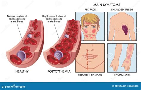 Medical Illustration With Polycythemia Cartoon Vector Cartoondealer