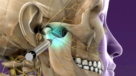 Sphenopalatine Ganglion Block Des Moines Iowa Spg Injection